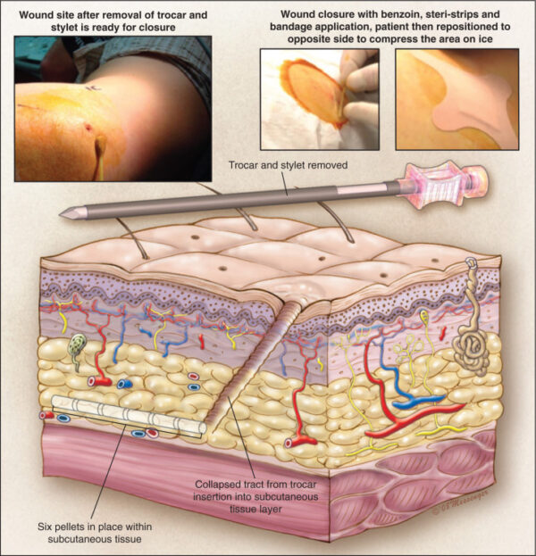 The Benefits of Hormone Pellet Therapy: A Comprehensive Guide